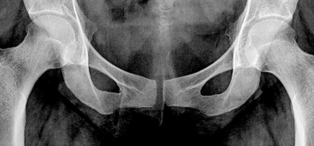 Non-radiographic and radiographic axSpA treatment